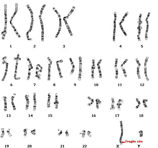 Fragile X Syndrome